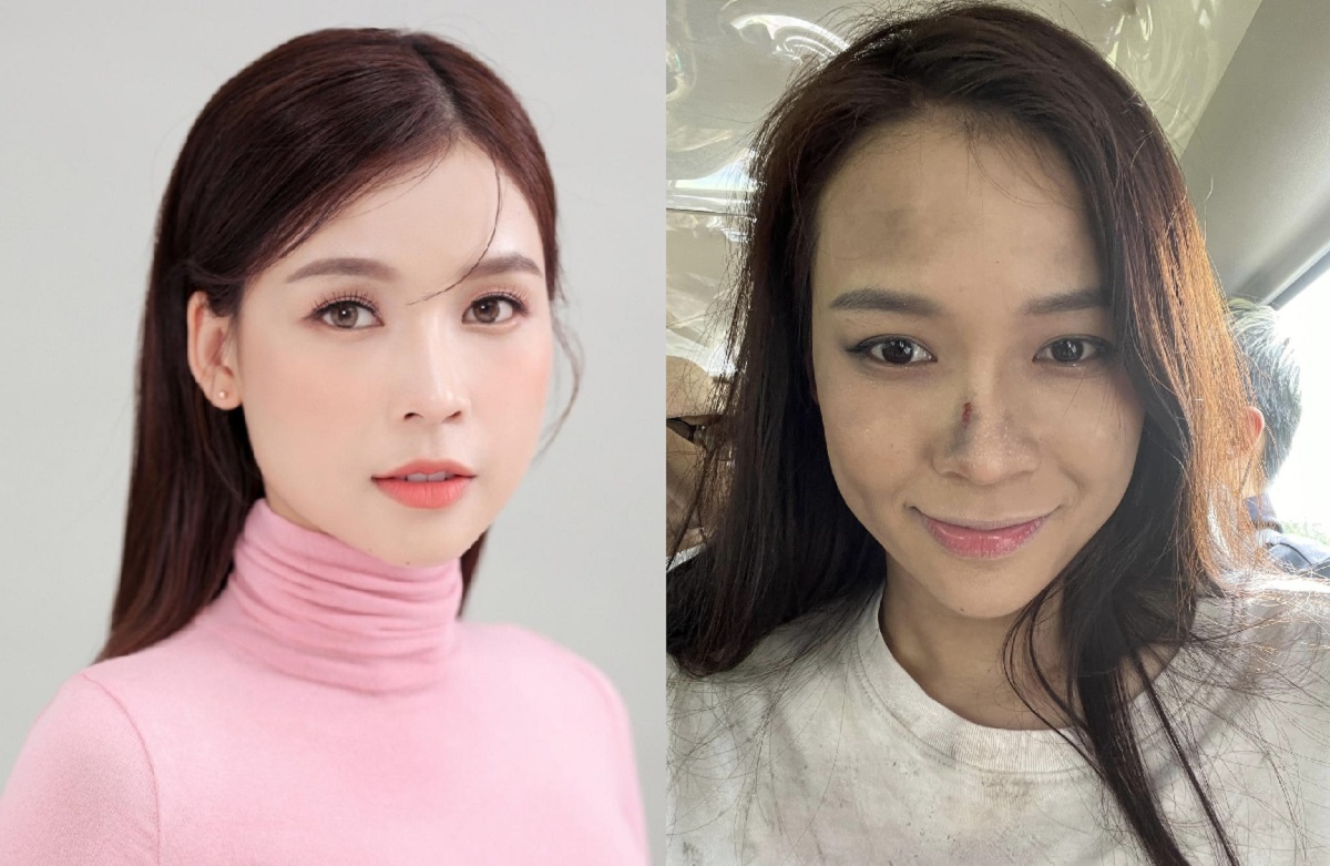 Sam bị dị ứng nặng, phải điều trị suốt 6 tháng sau khi tham gia vào dự ...