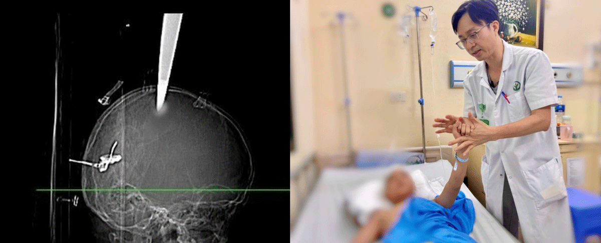 Nguyên nhân bé trai 11 tuổi bị dao cắm trên đỉnh đầu, xuất hiện tình ...